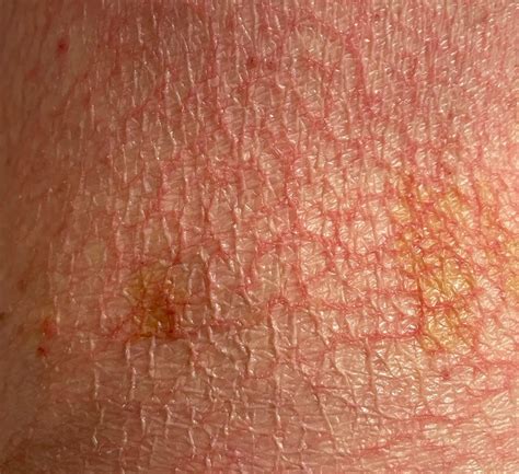 Lacy Rash Rdermatologyquestions