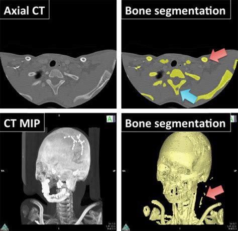 Automatic Segmentation Of Head Ct Dataset Top Segmentation Results Download Scientific