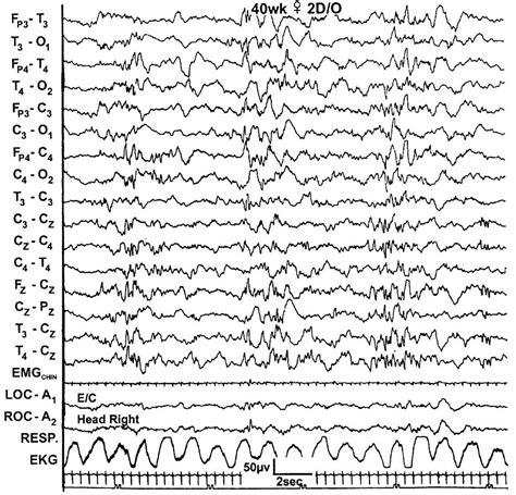 An Eeg Segment Of A 40 Week 2 Day Old Female Documenting A
