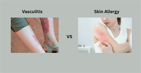 वास्कुलाइटिस और एलर्जी में मुख्य अंतर