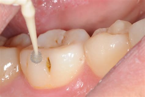 Silver Diamine Fluoride Clinical Cases Centrix