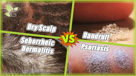 Seborrheic Dermatitis And Psoriasis Difference At Diana Andrzejewski Blog