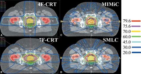 Radiation Therapy Imrt All About Radiation