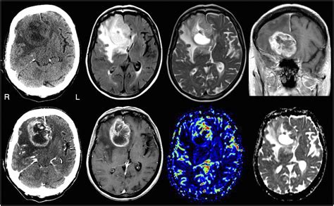 Cat Scan Brain Tumor