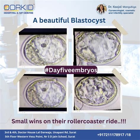 Do You Know Pregnancy Success Rates Are Higher With Blastocyst Transfers Depending Upon Pts
