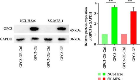 Gpc3 Expression In Lung Squamous Cell Carcinoma Lusc Cell Lines And