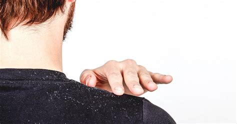 Is Dandruff Contagious And Other Flaky Questions
