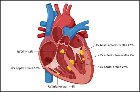 Electrophysiological Characteristics And Ablation Outcomes In Patients With Catecholaminergic