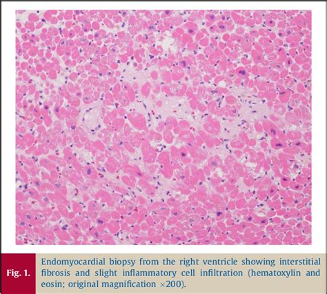 Figure 1 From Six Recurrences Of Myocarditis In 3 Years A Case Report