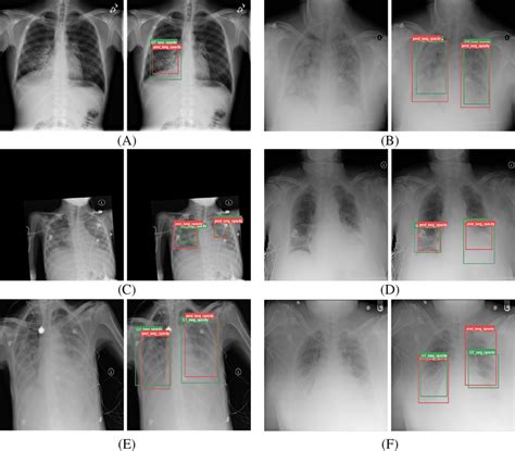 Visualization Of Lung Opacity Detection Applying Our Detector Six Download Scientific Diagram