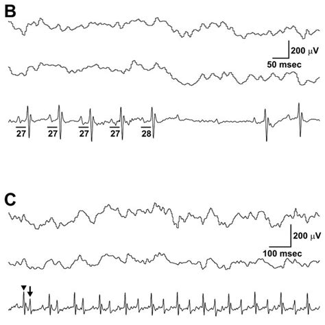 Simultaneous Eeg Ecg Reveals Interictal Cardiac Abnormalities