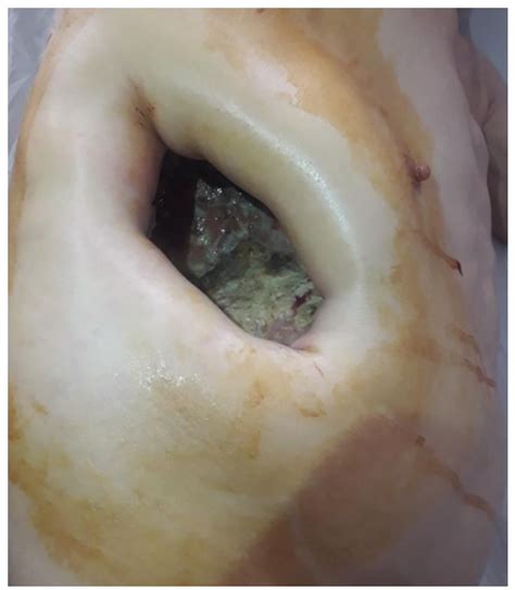 Open Window Thoracostomy For A Calcified Pleural Empyema Download Scientific Diagram