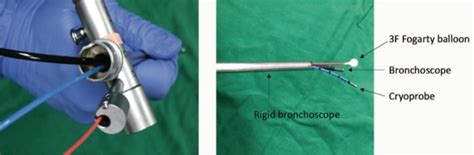 Modified Transbronchial Lung Cryobiopsy Technique Used In This Case