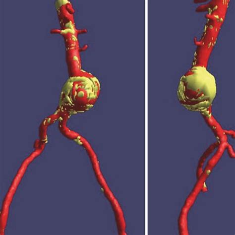 Medtronic Endurant Stent Graft Download Scientific Diagram
