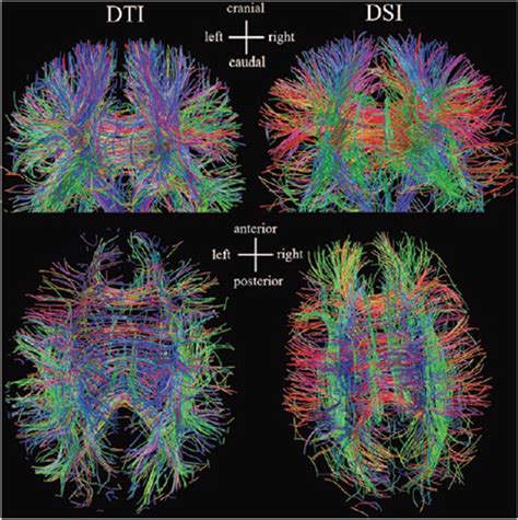 Current State Of Diffusion Weighted Imaging And Diffusion Tensor