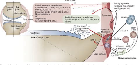 Osteophytes And Osteoarthritis Differentiation Of Osteophyte Types In