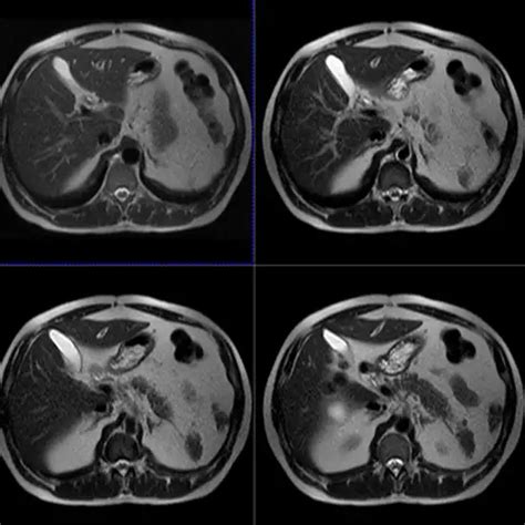 Mri Whole Abdomen And Mrcp Medifyhome