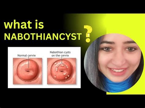 What Is Nabothian Cystnabothian Cyst Kya Hota Haicausesriskfactor