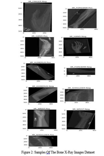 bone abnormalities detection and classification using deep learning