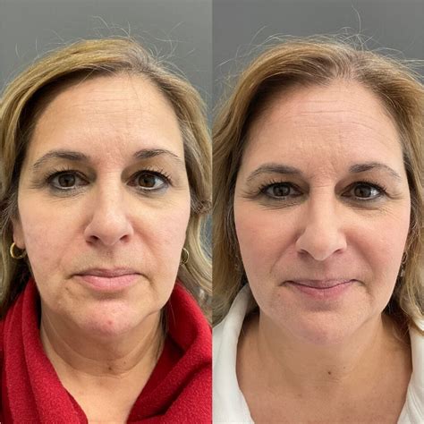 Laser Resurfacing Before And After Oakville On Nurse Jacklyn