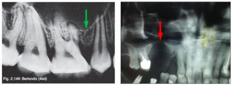 Deep Face Infratemporal Fossa Flashcards Quizlet
