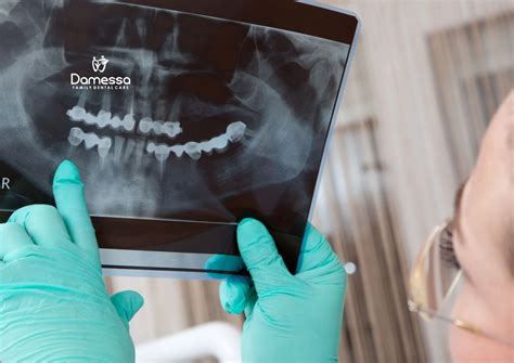 10 Gejala Awal Gingivitis Kenali Gejala Sejak Dini