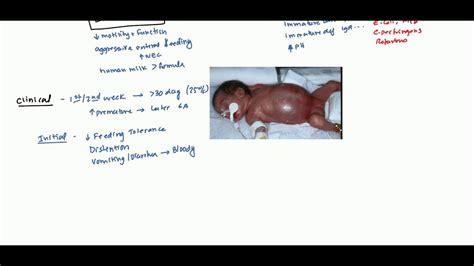 Necrotizing Enterocolitis For Usmle Youtube