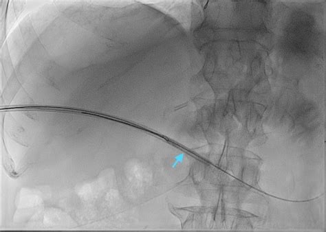 Percutaneous Biliary Stent Removal For Benign Biliary Stricture Post Hepaticojejunostomy Bmj