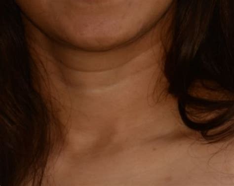 Why Do I Have Lines On My Neck Pregnancy Informations