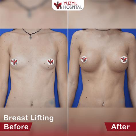 Breast Lifting
