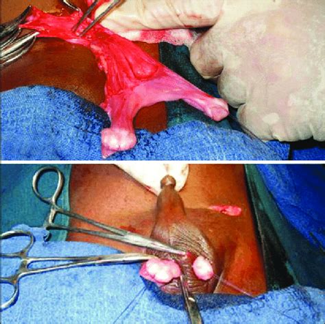 Mullerian Remnants Retained After Left Herniotomy Both Testes Brought Download Scientific