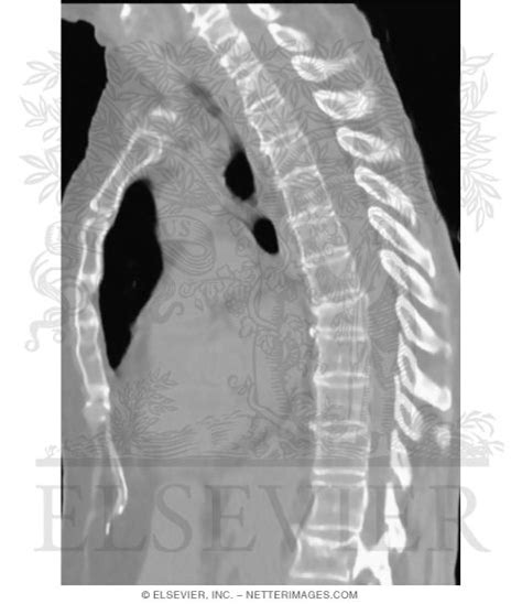 Sagittal Ct Reconstruction With A Bone Window Setting