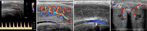 Venous Occlusive Erectile Dysfunction Images Obtained After Cavernosal