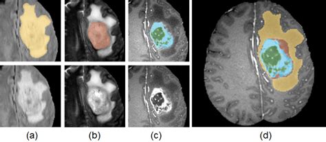 Intra Tumoral Structures Appearance On Three Imaging Modalities With Download Scientific