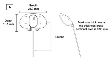 Paul Glaucoma Implant Eyewiki