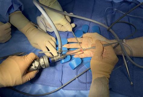 Surgical Setup Using 27 Mm Arthroscope With Endosleeve Attachment