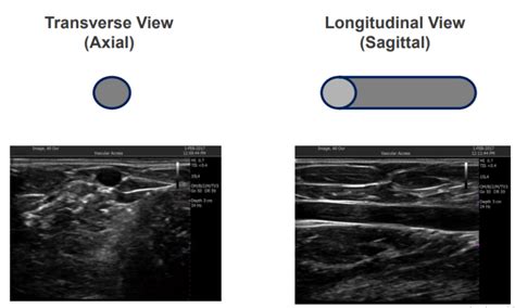 Peripherally Inserted Central Catheter PICC Article
