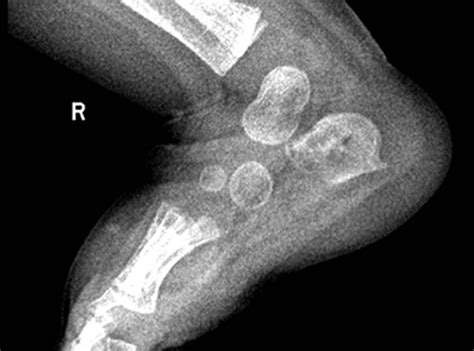 A Case Of Early Onset Congenital Syphilitic Osteomyelitis Of The