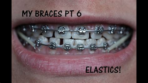 Elastics 5 Month Update Braces Pt 6 Youtube
