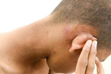 Chickenpox Scars Causes Treatment Options And Prevention Strategies