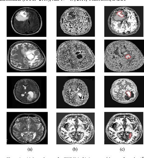 Figure 3 From Tumor Detection In Brain Mri Image Using Template Based K Means And Fuzzy C Means