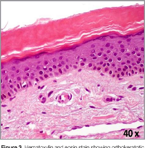 Figure 3 From Acquired Ichthyosis Revealing An Underlying Hodgkins Lymphoma Semantic Scholar