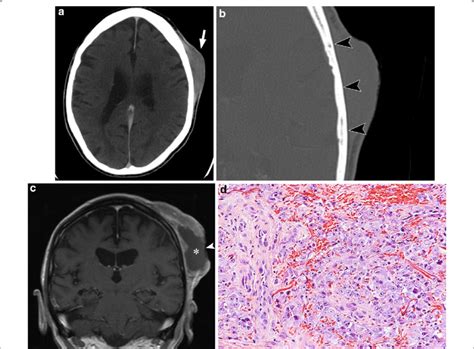 77 Year Old Man With Cutaneous Scalp Angiosarcoma A Axial Download Scientific Diagram