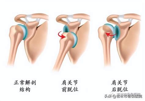 肩關節脫位症狀與手法復位 每日頭條