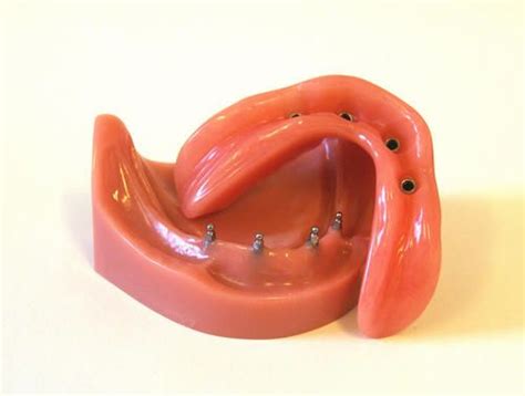 Upper Mini Dental Implants Dentures Find Local Dentist Near Your Area