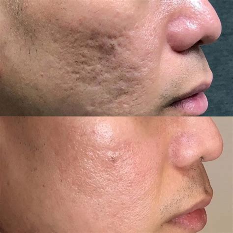 Co2 Laser For Scars Treatment All You Need To Know Artofit