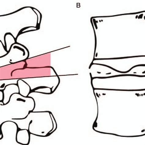 The Four Types Of The Roussouly Sagittal Classification The Shape Of