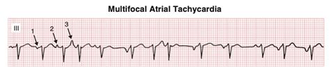 Multifocal Atrial Tachycardia Strip