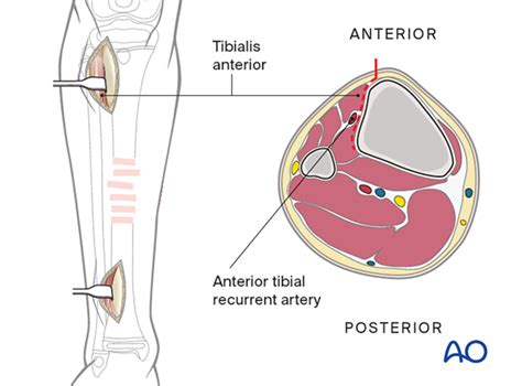Minimally Invasive Lateral Approach To The Tibia