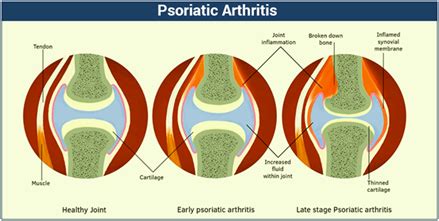 Psoriatic Arthritis Symptoms Causes And Treatment